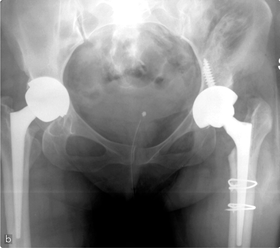 L'intervento di protesi d'anca | ior